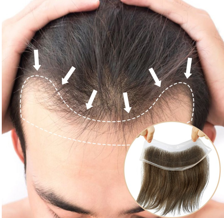 Transform Your Look: Effective Strategies for Men with Hair Patches ...